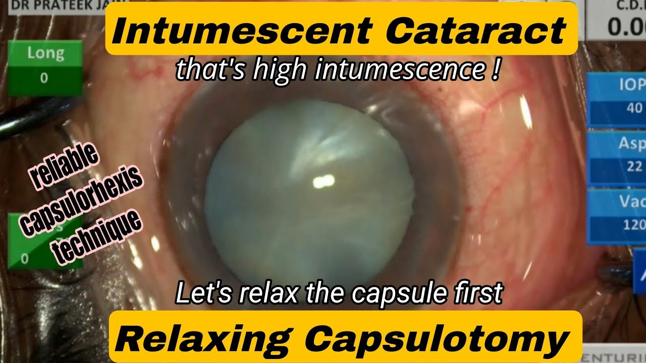 #273 Is Relaxing Capsulotomy a safe capsulorhexis technique for ...