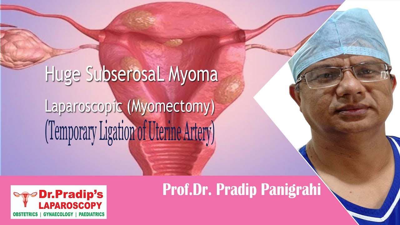 Huge Subserosal Myoma Laparoscopic(Myomectomy)/(Temporary Ligation Of ...