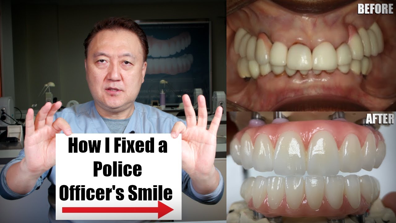 Step-By-Step: How I Fixed a Police Officer's Smile - YouTube