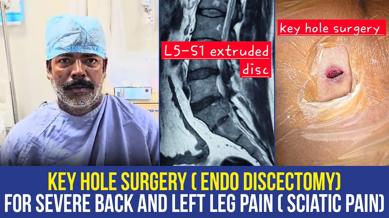 Key Hole Surgery (Endo Discectomy) for Severe Back and Left Leg Pain ...