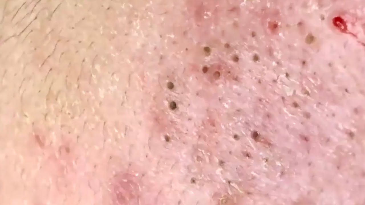 🔥 Pimple Popping 2020 Video| blackheads extraction| Blackheads removal ...