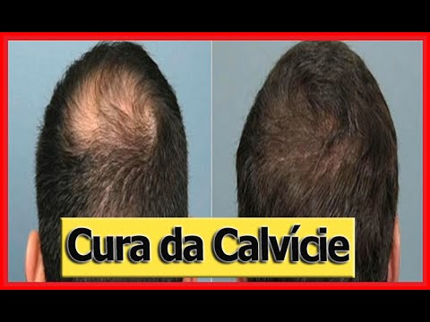Cura da Calvície - Brasileiro Descobre Tratamento Sem Precisar Rémedio e Cirurgias