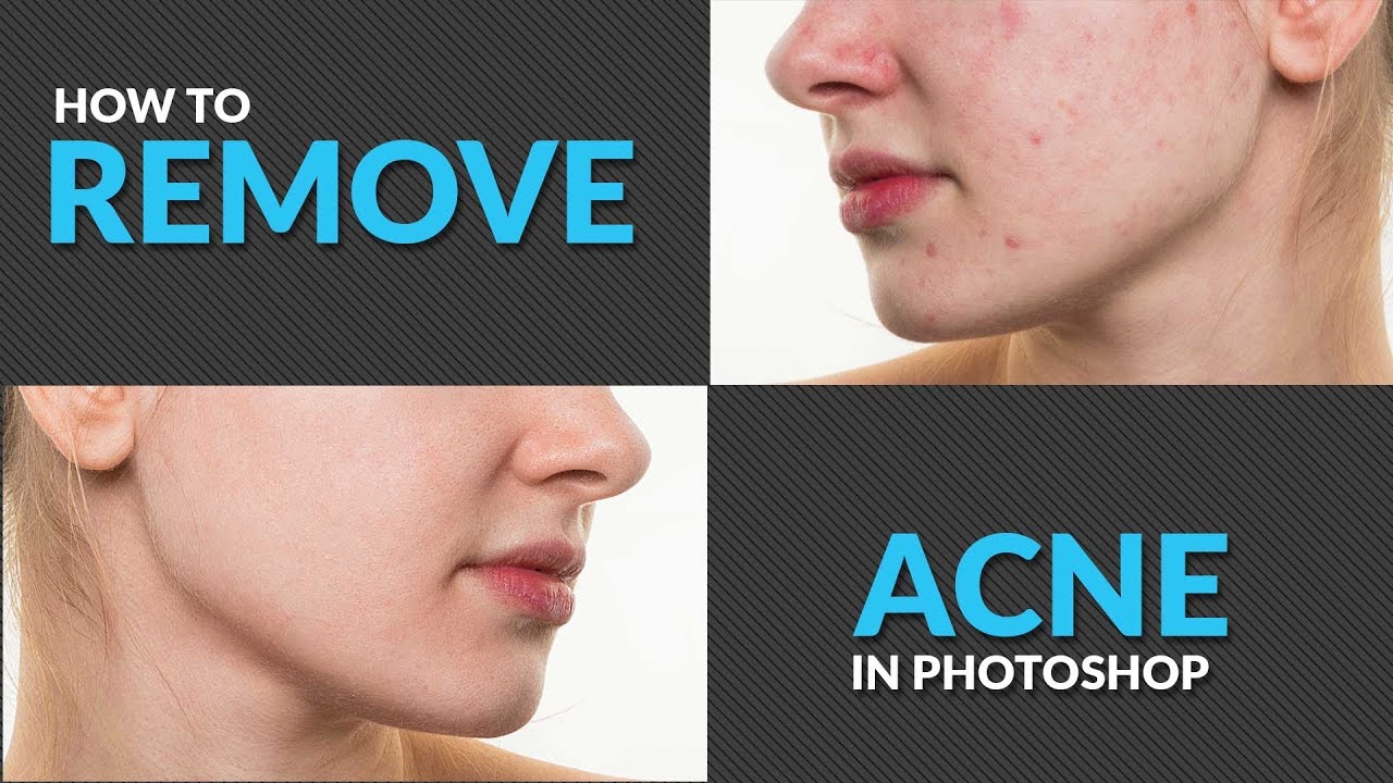 How To Remove Acne In Photoshop YouTube how-to-remove-acne-in-photoshop-youtube