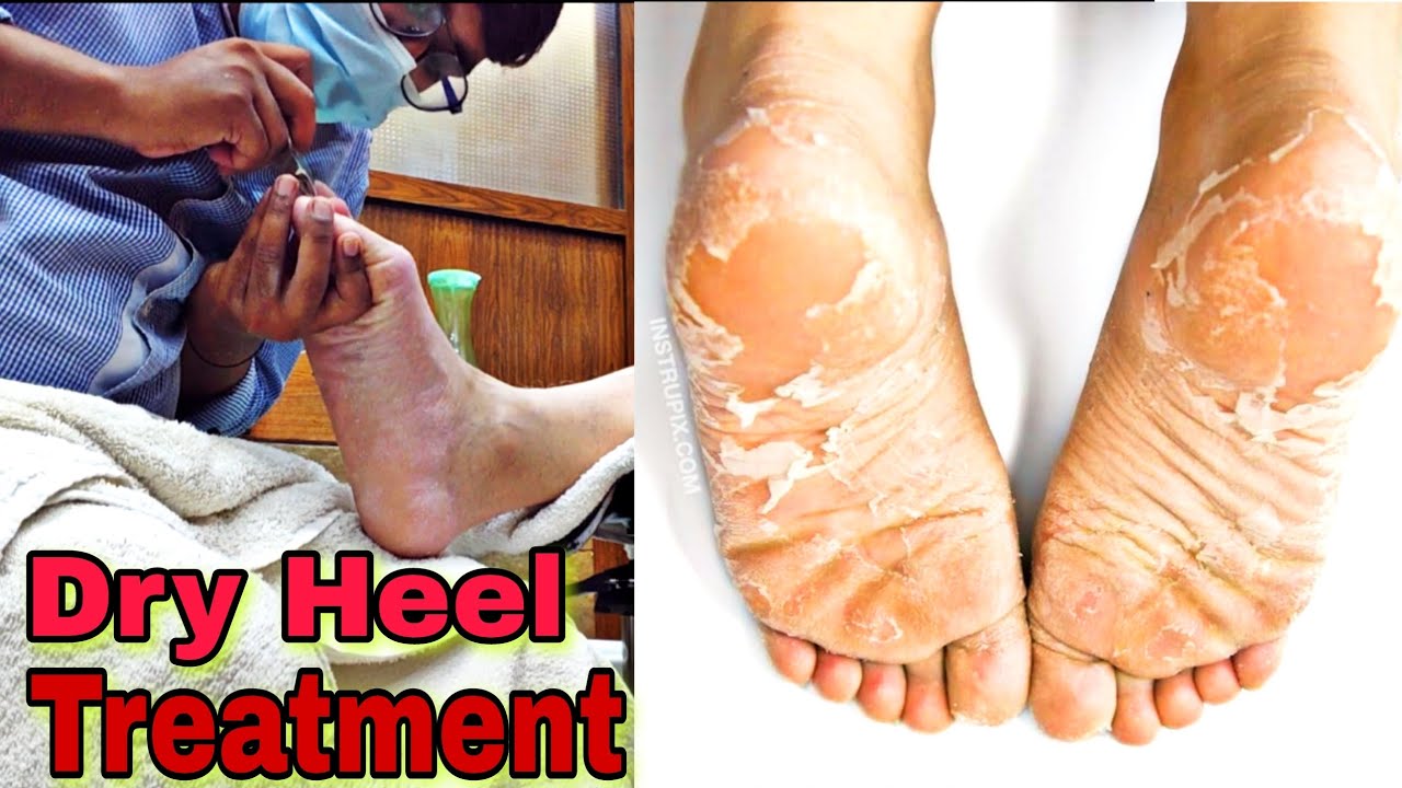 Pedicure Dead Skin Heel /Treatment /Madicated/Smooth Foot 👣/#pedicure # ...