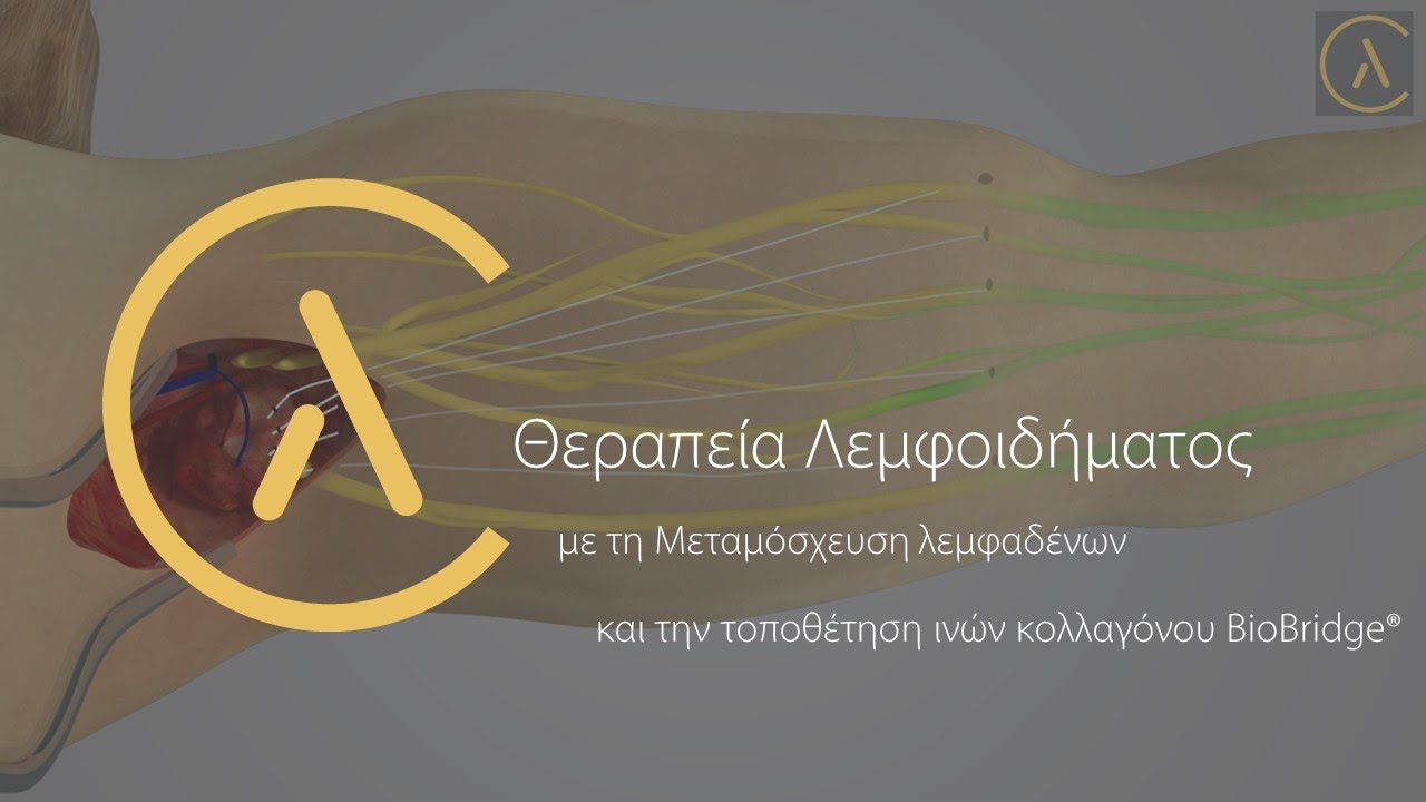 Θεραπεία λεμφοιδήματος με τη Μεταμόσχευση λεμφαδένων και την τοποθέτηση ...
