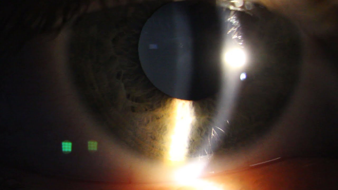 Epicapsular Stars Pigment on Anterior Lens from Iris - YouTube