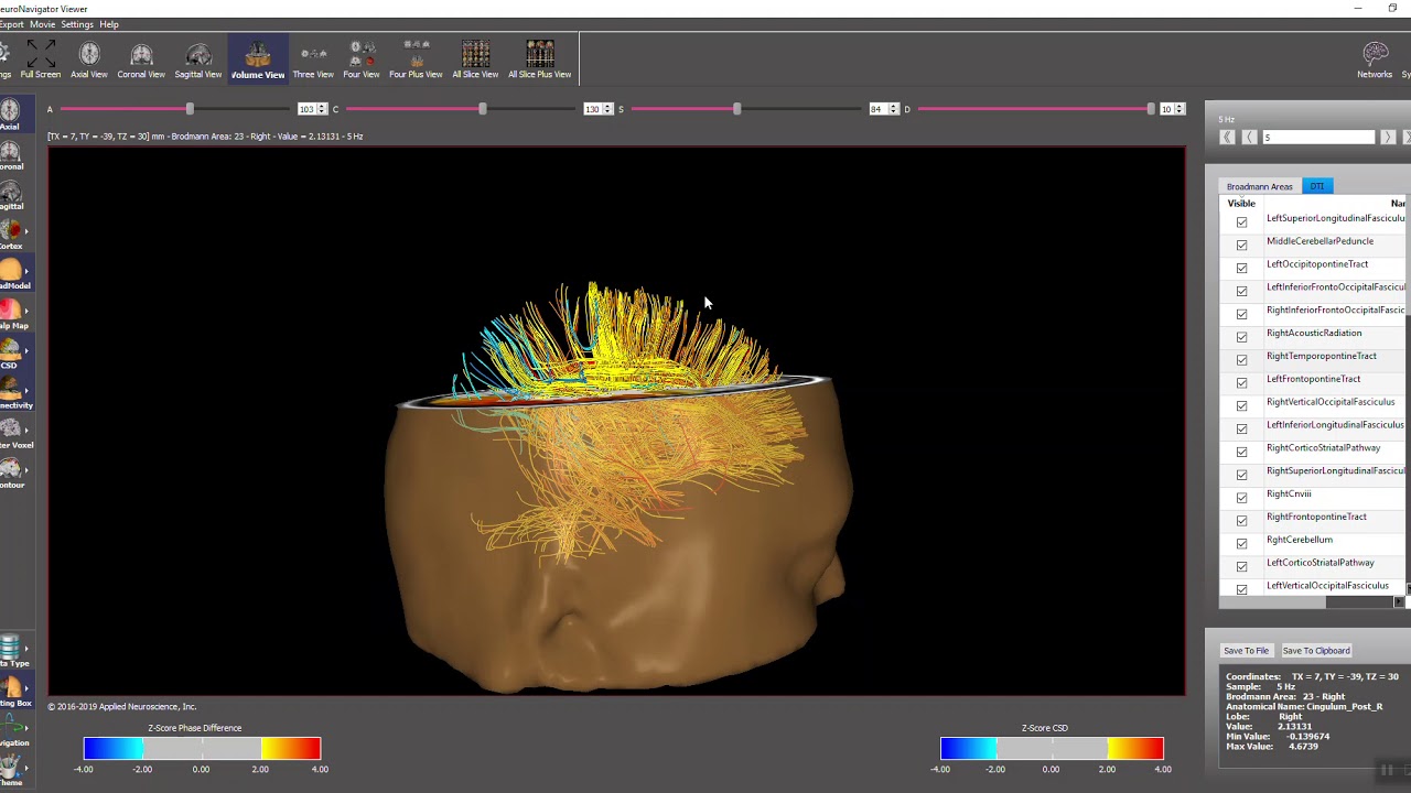 NeuroGuide NeuroNavigator with DTI All Fiber Bundles - YouTube