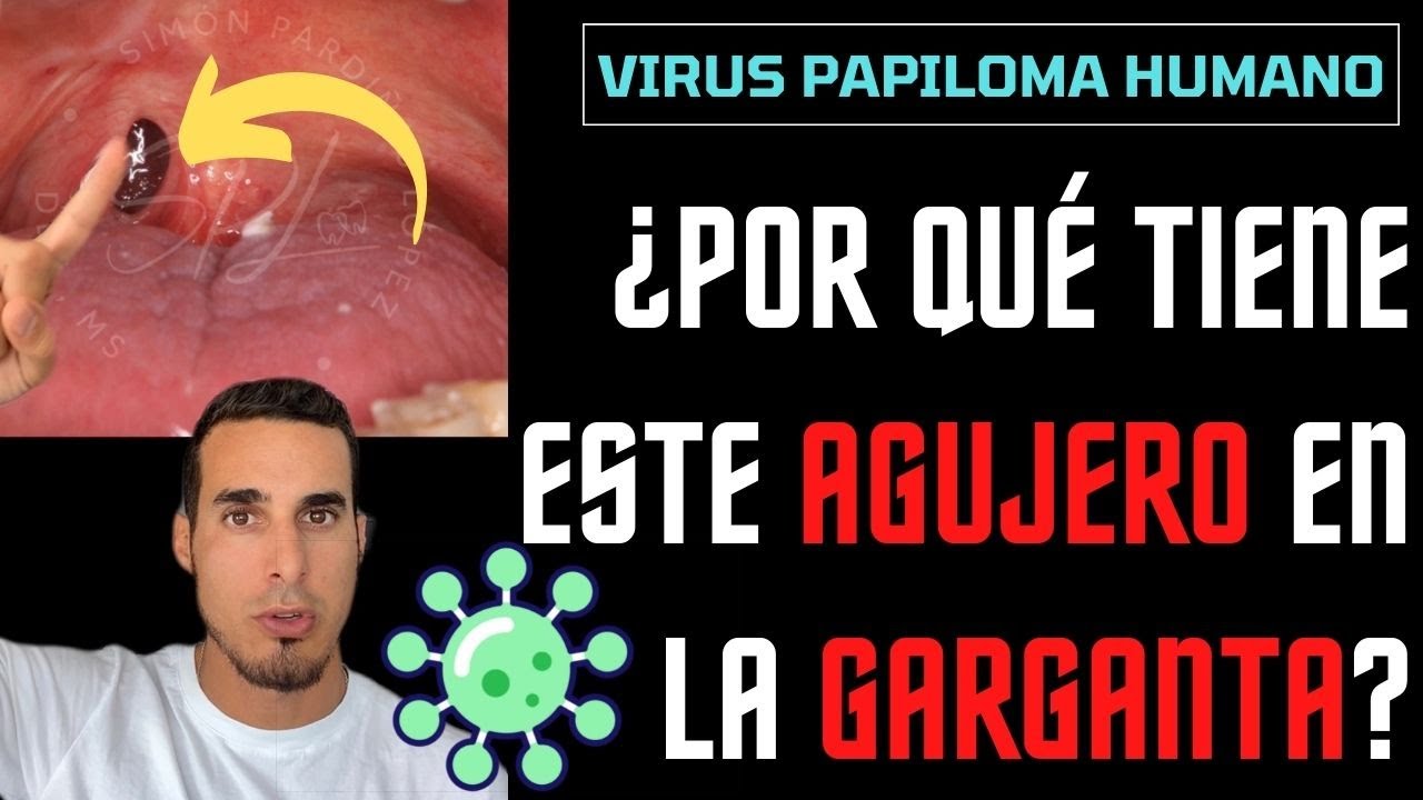 Increíble AGUJERO en la GARGANTA - Virus del PAPILOMA HUMANO - YouTube