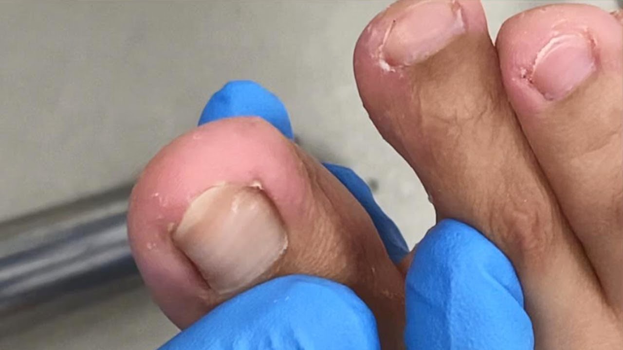 Deep nail hiding in corner but take it effectivly【Xue Yidao】 - YouTube