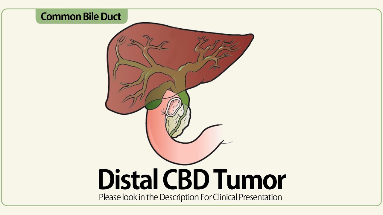 Distal CBD Tumor - YouTube