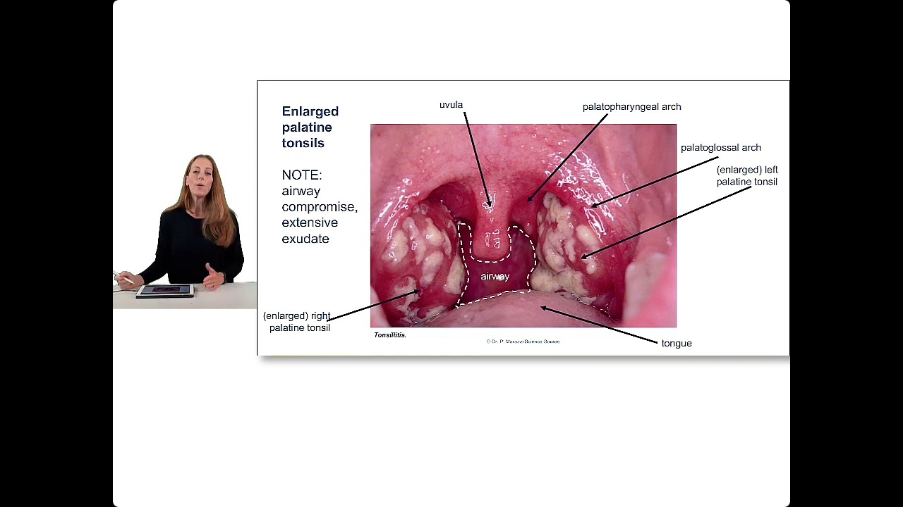 Palatoglossal Arch Infection