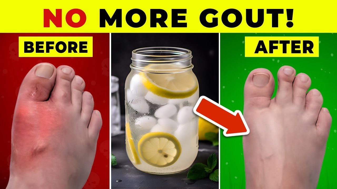 Top Drinks To Help PREVENT and REDUCE Gout NATURALLY! - YouTube