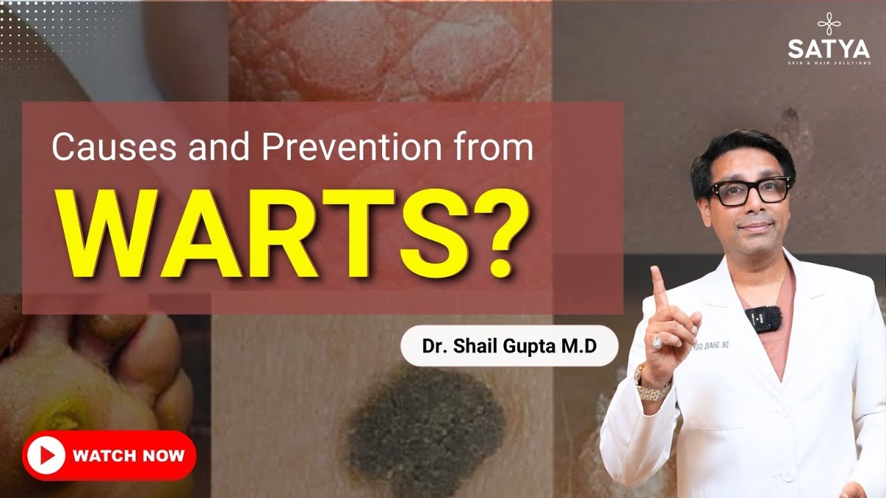 Types of Warts | Causes of Skin Warts | How to Prevent Skin Warts | How ...