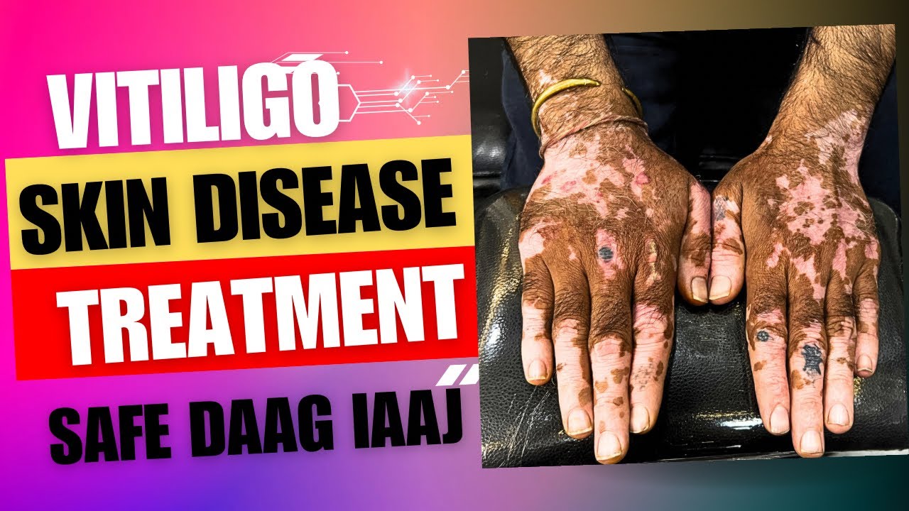 VITILIGO SKIN DISEASE TREATMENT| NEW VITILIGO TREATMENT|VITILIGO ...
