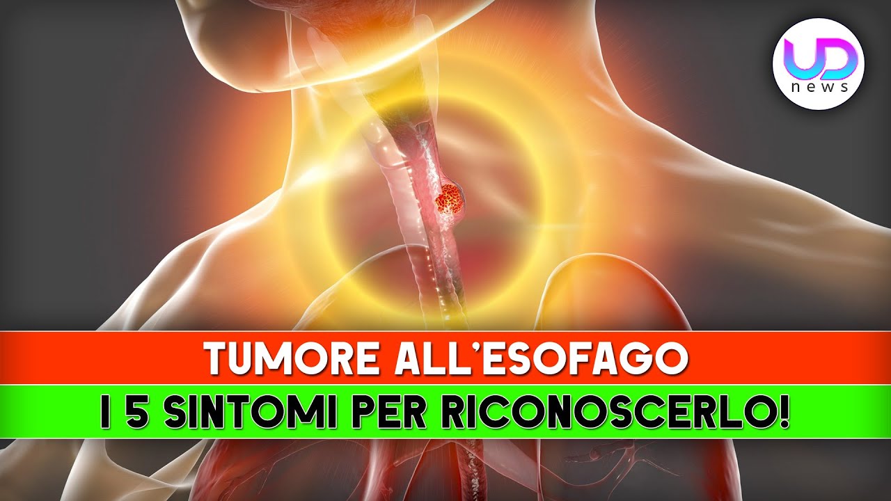 Tumore All'Esofago: I 5 Sintomi Per Riconoscerlo! - YouTube