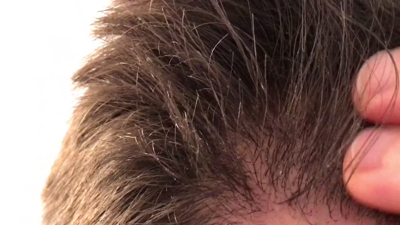 Fue Hair Transplant Day 153 Post Op Recovery Youtube