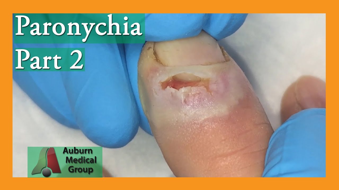 Paronychia Part 2 | Auburn Medical Group - YouTube