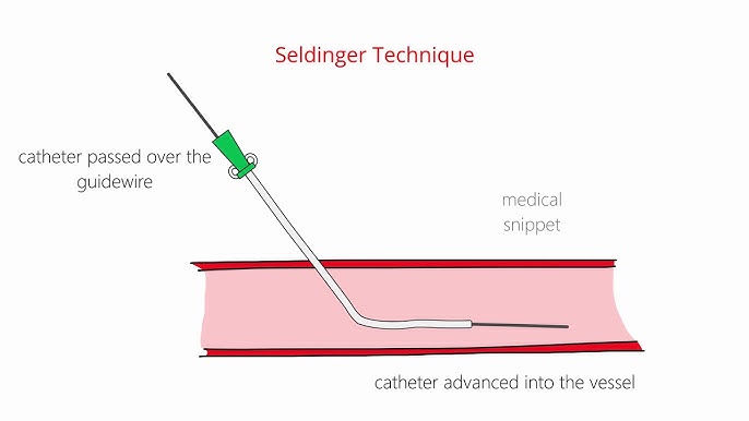 Ultrasound-Guided Peripheral IV Insertion, Placement, And, 42% OFF Ultrasound-Guided Peripheral IV Insertion, Placement, And, 42% OFF