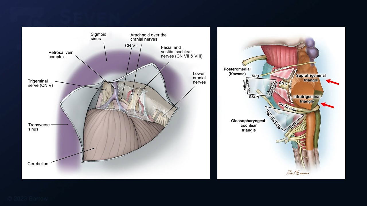 Extended Retrosigmoid Craniotomy For Resection Of A Petrotentorial extended-retrosigmoid-craniotomy-for-resection-of-a-petrotentorial