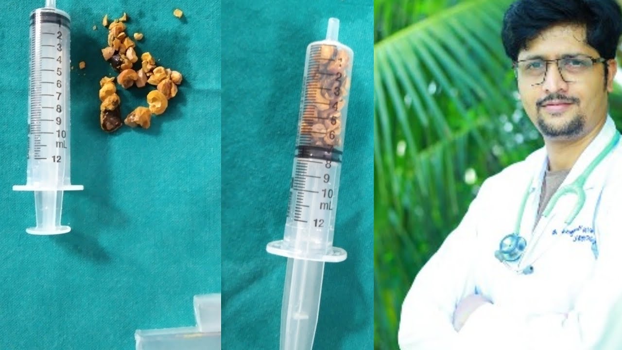 MEATOTOMY FOR BILATERAL LARGE VUJ CALCULI - YouTube