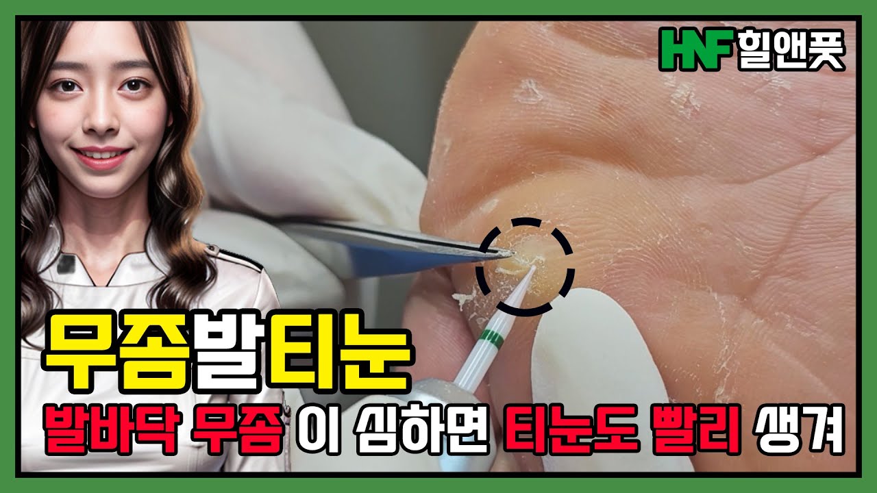 [ASMR] 무좀발티눈 :: Fungal Foot Corn :: 티눈 :: Corn :: 무좀 :: Athlete's foot ...