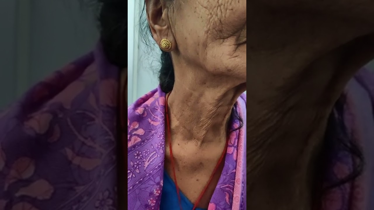 Jugular Venous Pulse - JVP - Waves of JVP - Identify the crests and ...