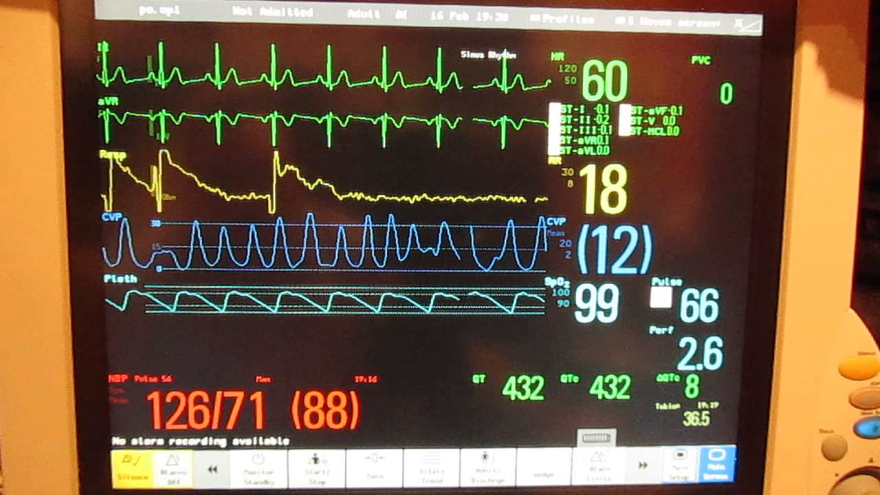 Co pokazuje kardiomonitor? - YouTube