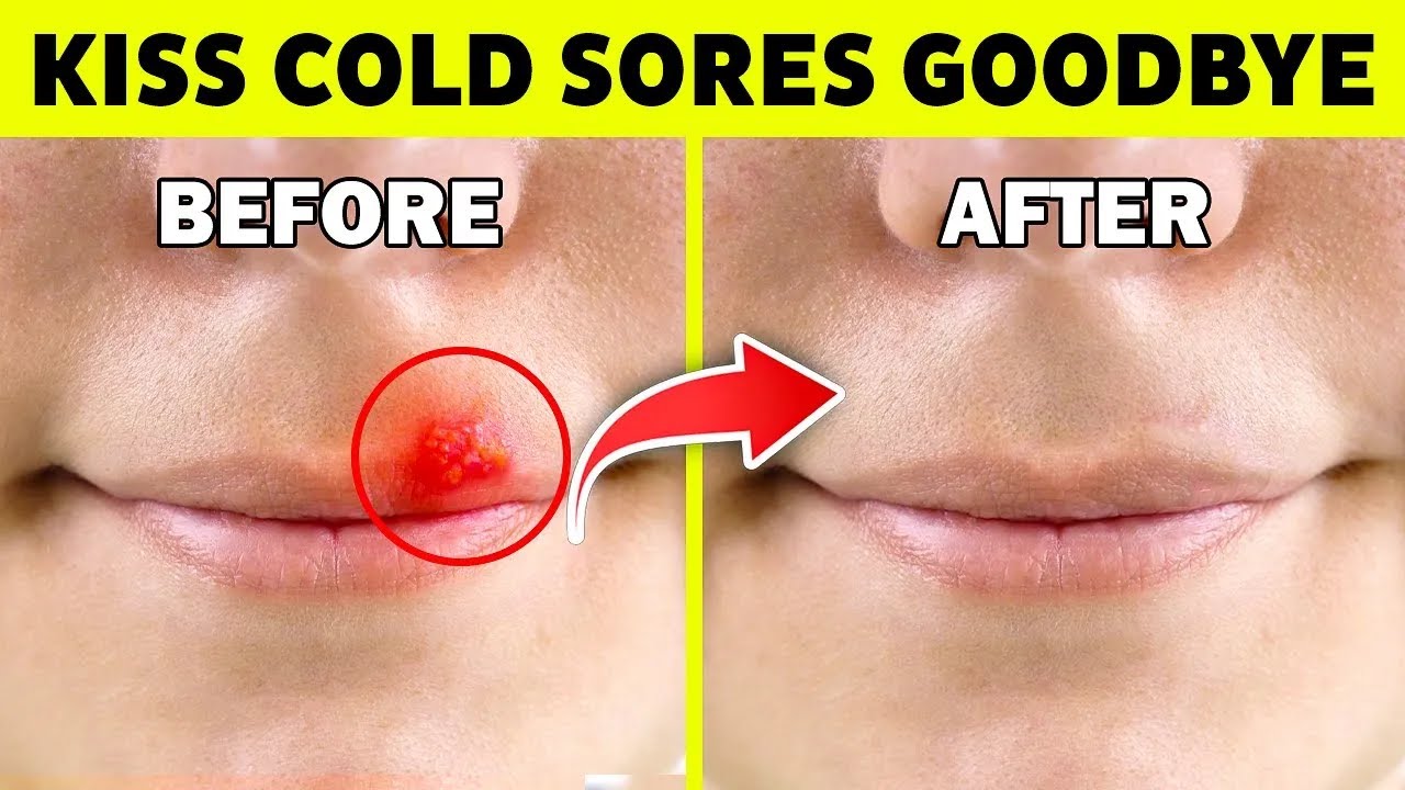 How to Get Rid of Cold Sores FAST (and Prevent Them from Coming Back ...