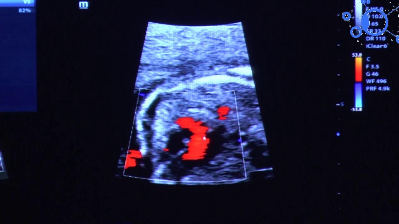 Fetal Cardiac Scan Demo by Prof Philippe Jeanty - YouTube