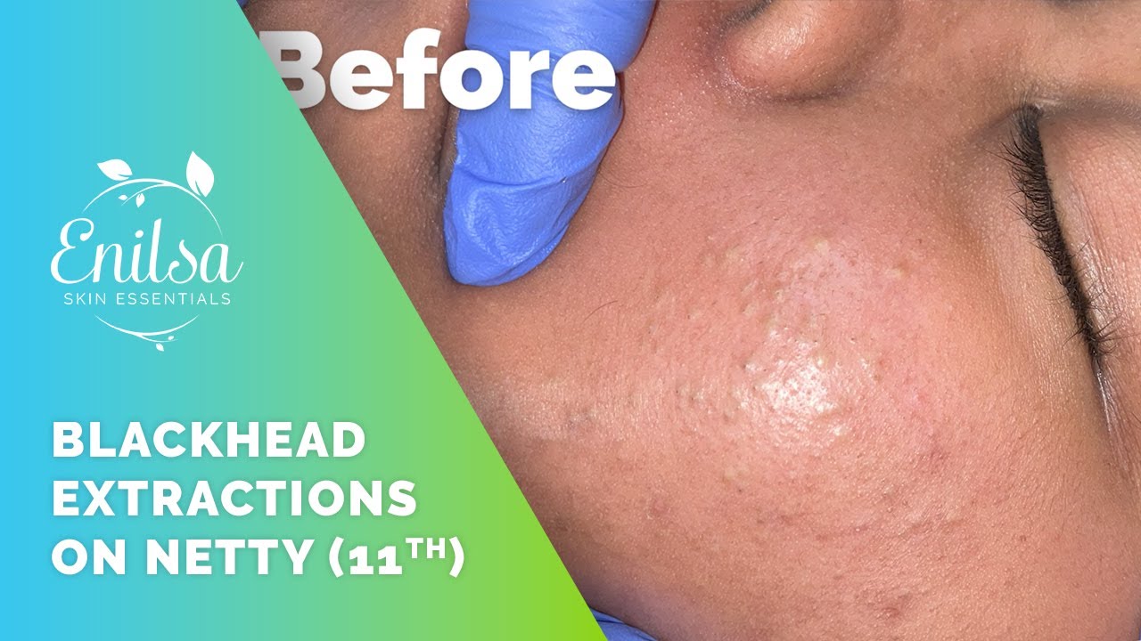 Blackhead Extractions on Netty - 11th Treatment - YouTube