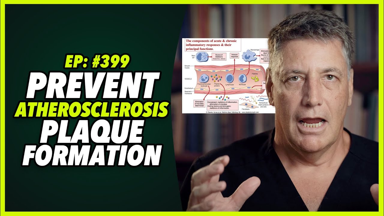 Ep:399 PREVENT ATHEROSCLEROSIS PLAQUE FORMATION - YouTube