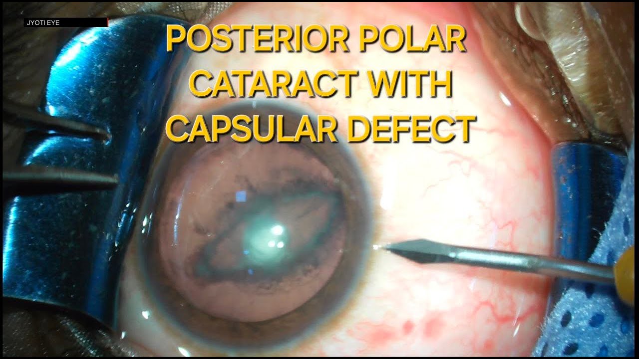 POSTERIOR POLAR CATARACT WITH POSTERIOR CAPULAR DEFECT - YouTube