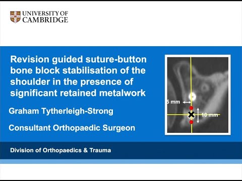 Rocky Mountain Shoulder 2024: Revision Suture-Button Bone Block ...