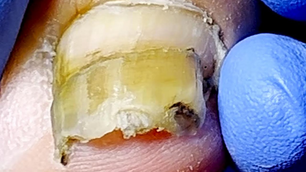 The Old Lady’S Nails Have Grown Very Thick And Have A Smooth Layer ...