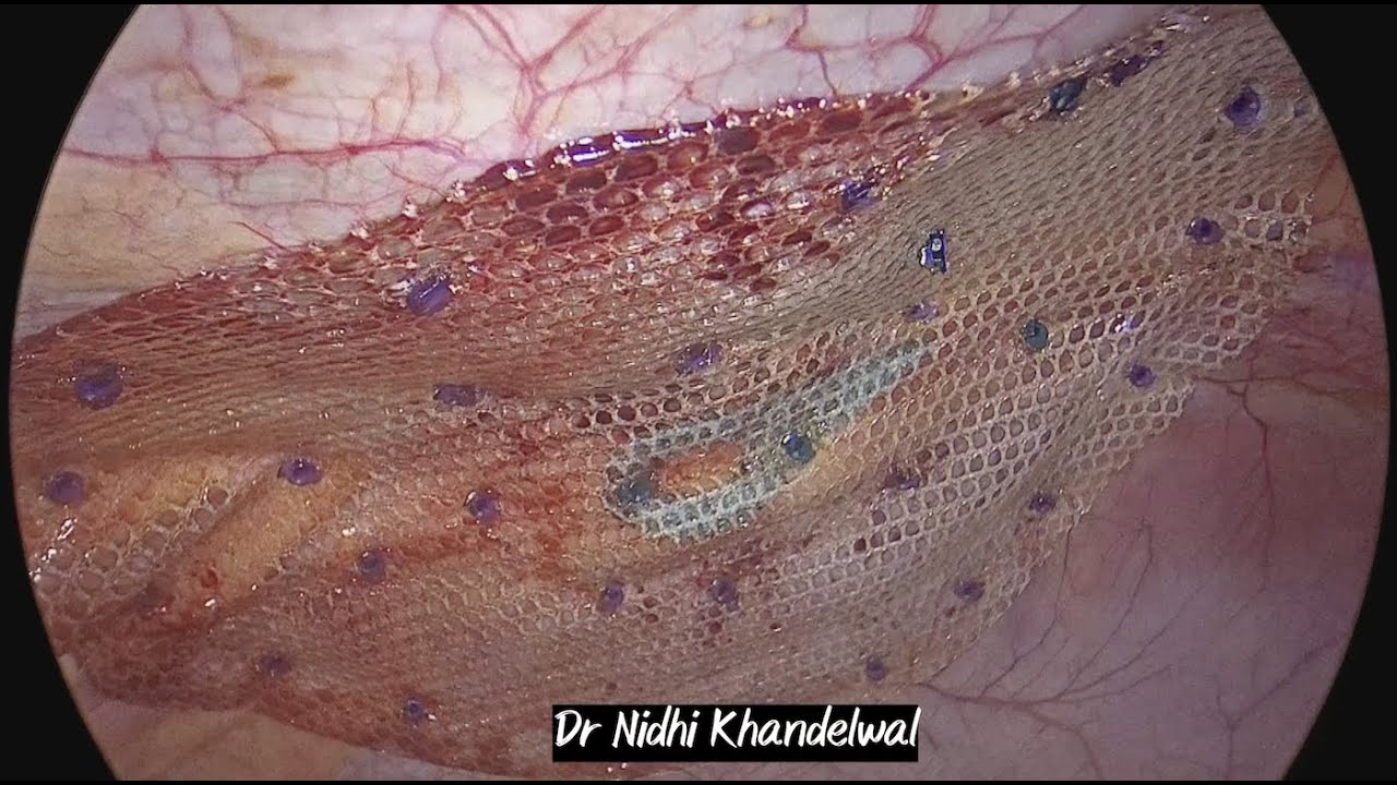 IPOM Plus: Using the Maxtack Tacker - YouTube