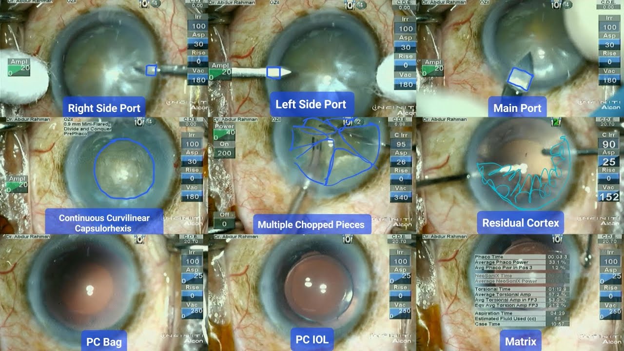 Cataract Surgery Insights Into Swollen cortex By Dr.Abdur Rahman ...