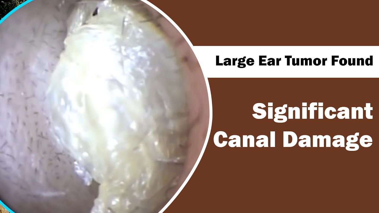 HARGE EAR TUMOR found Significant Canal Damage | earwax removal - Dr ...