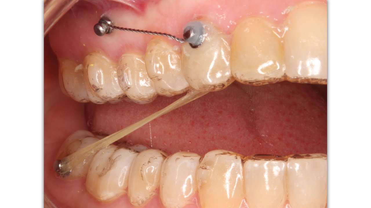 INVISALIGN: Claves para un DISTALAMIENTO SECUENCIAL EFICAZ Y PREDECIBLE ...