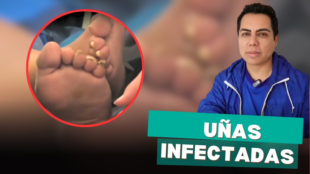 JAVIER DERMA REACCIONA A VIDEO DE UÑAS INFECTADAS - YouTube