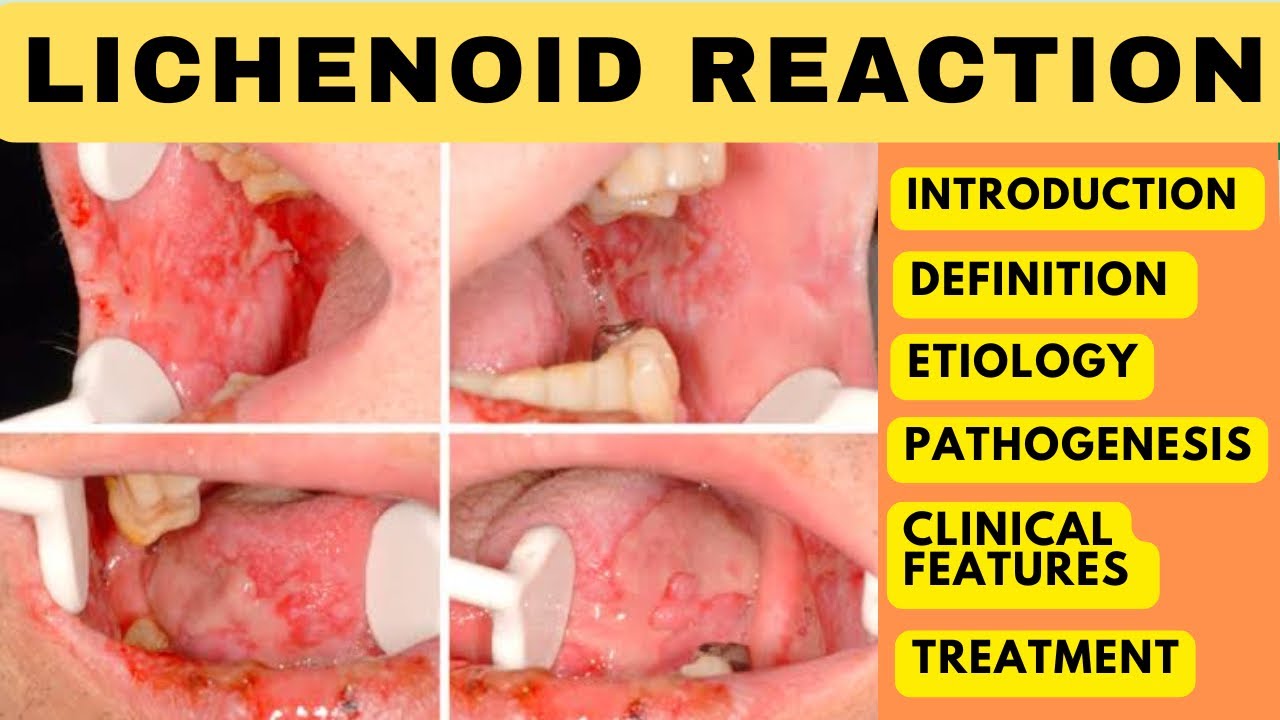 Lichenoid Reaction | Definition, Pathogenesis,Clinical Features ...