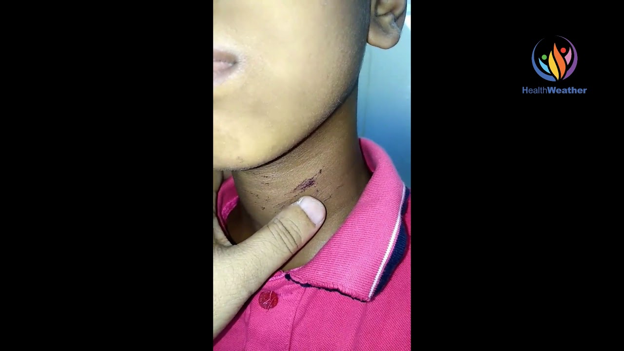 Subcutaneous Emphysema My Patient - YouTube