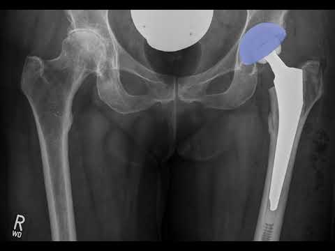 Hip and Knee Academy – Röntgen HTP teilzementiert - YouTube