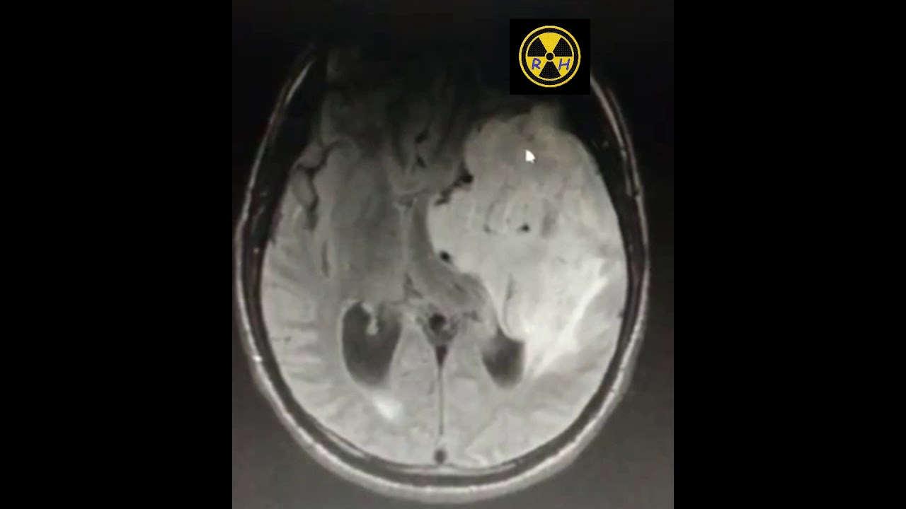 HÉRNIA DE UNCUS - YouTube