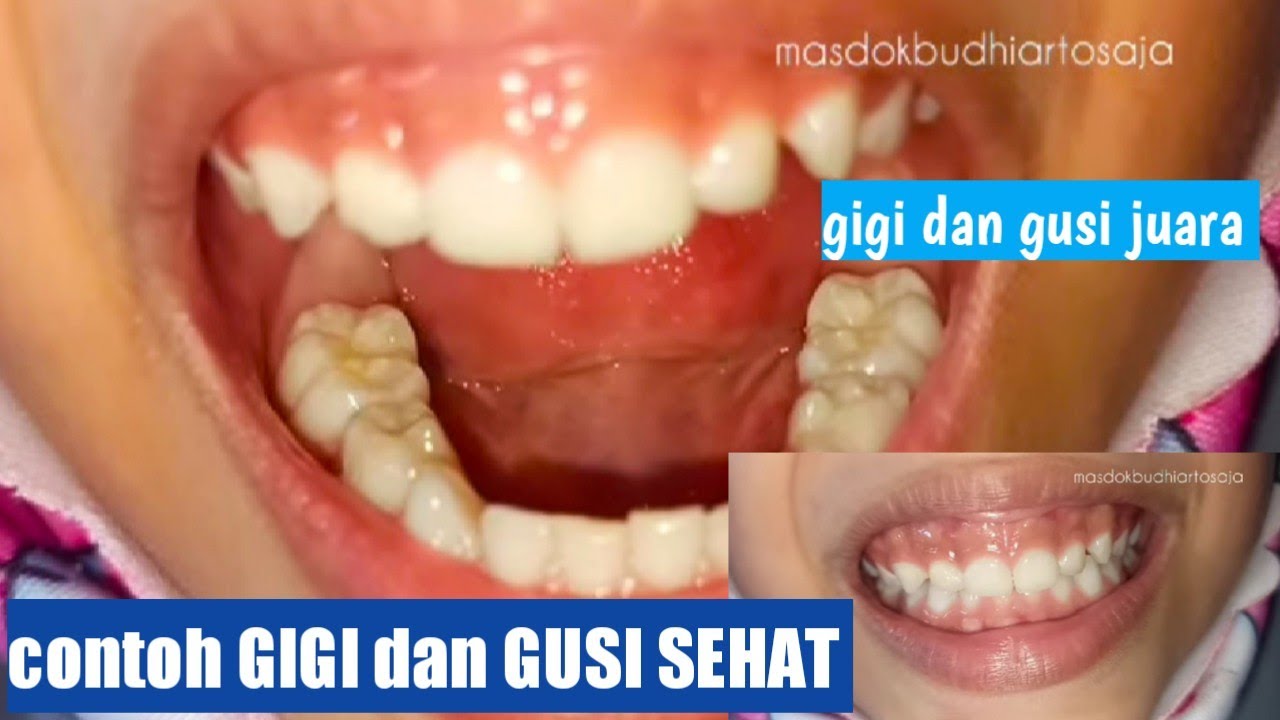 contoh gigi dan gusi yang sehat pada anak usia dini - YouTube