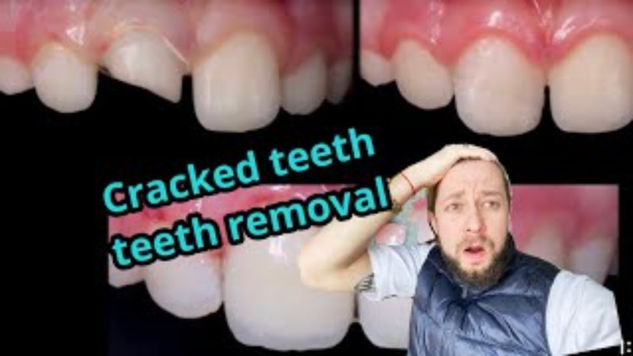 Cracked teeth | teeth removal | #dentist #dentistry #teeth #veneers # ...