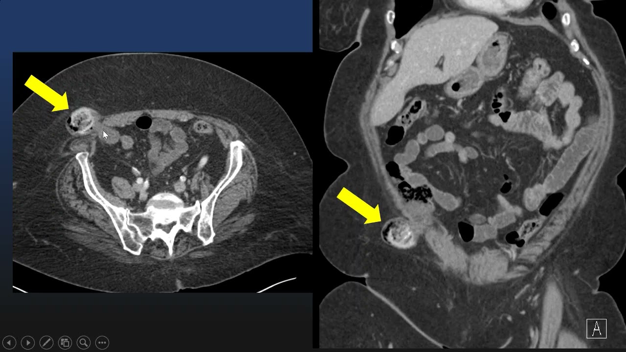 Imaging Abdominal wall and peritoneum - YouTube