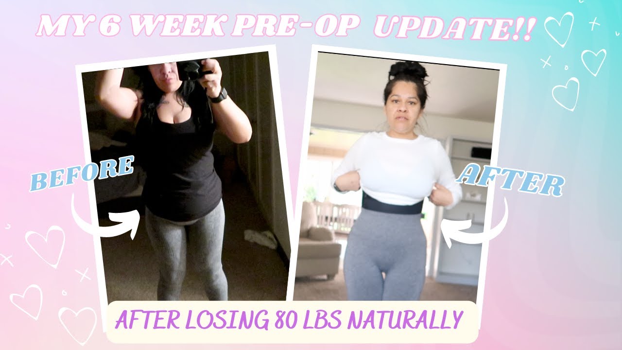 Sad News/My 6 week pre-op update/Before & After/After losing 80 lbs ...