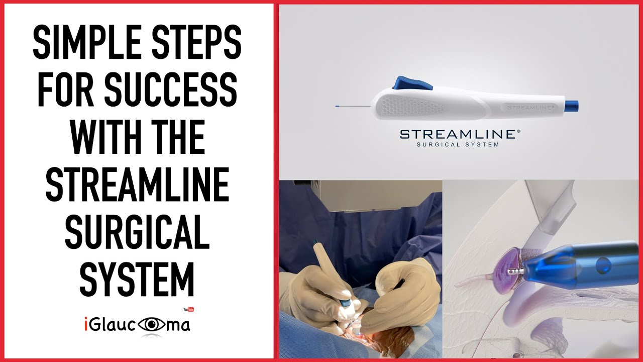 Streamline Surgical System - Simple Steps for MIGS Success in Glaucoma ...