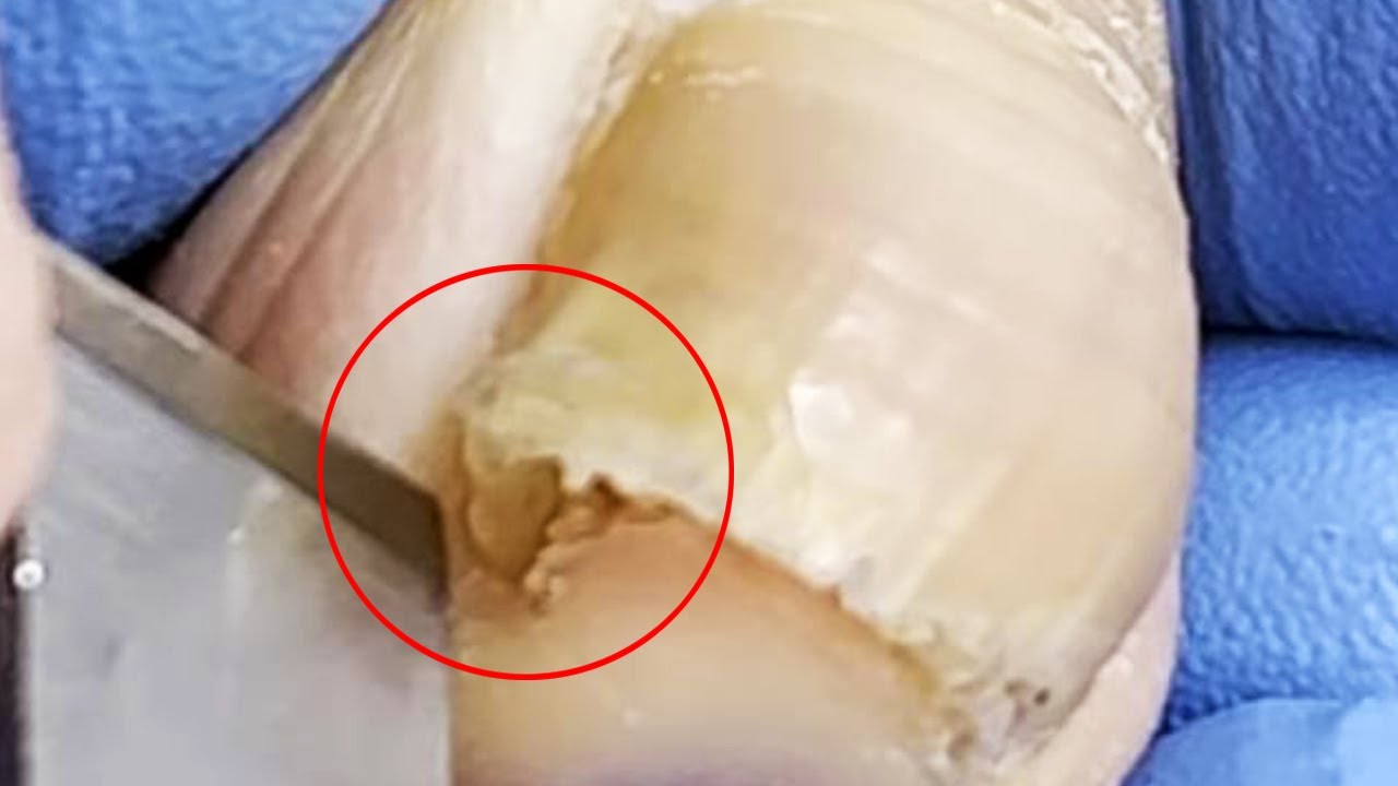 Very curly large ingrown nails, pedicure for women【Xue Yidao】 - YouTube
