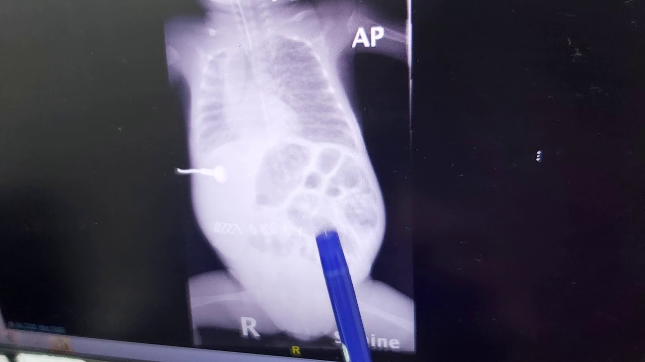 Workshop 34 hyperinflation waveform interpretation, congenital lober ...